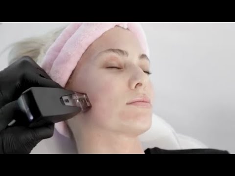 Morpheus8 Face Treatment & Microneedling Procedure | Vitalyc Medspa Dallas TX