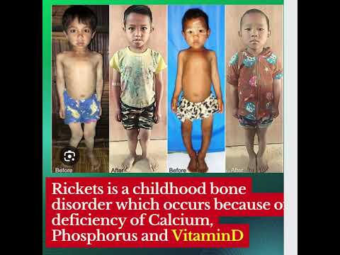 Understanding Rickets: A Childhood Bone Disorder