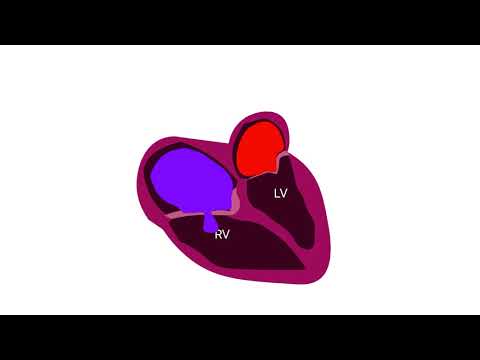 What happens in ASD? Hemodynamics in ASD illustration