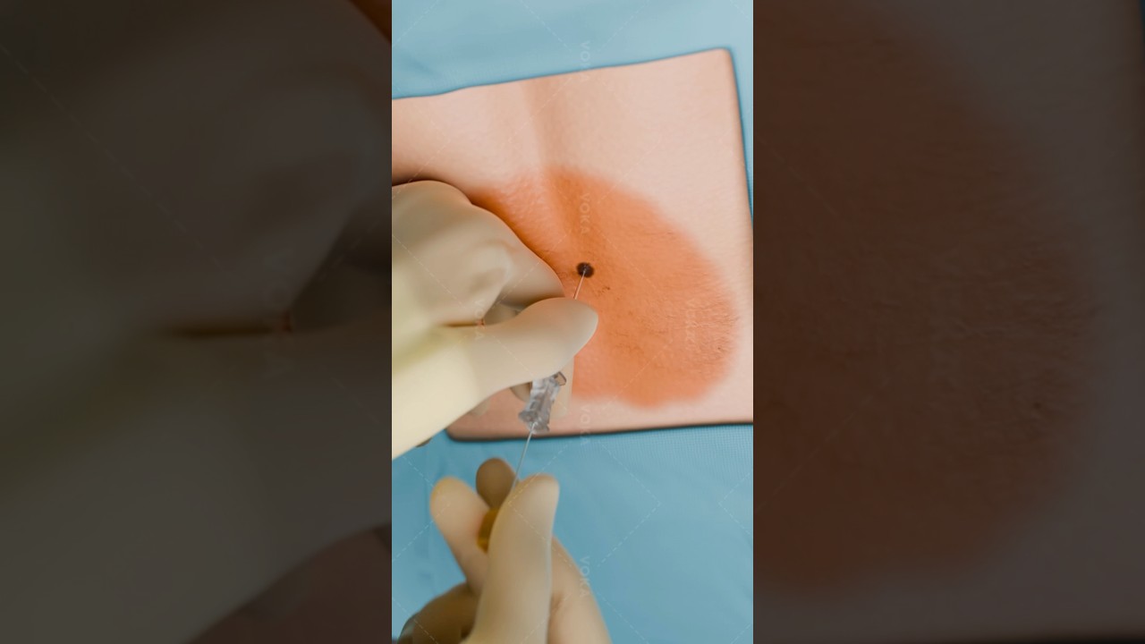 What happens during a lumbar puncture? 3D animation