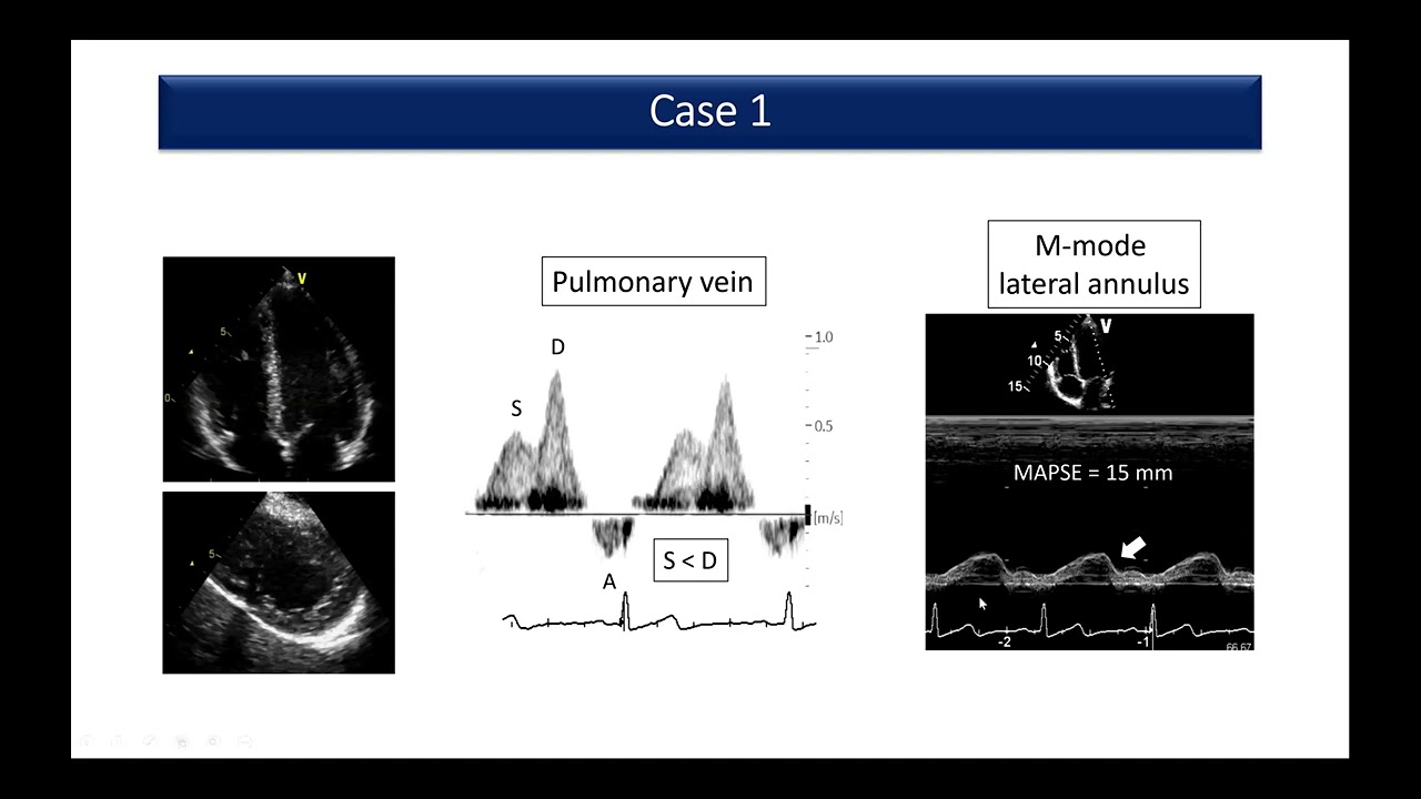 Diastolic Dysfunction, Dr. Baha fadel