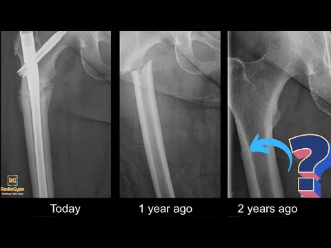 Atypical Femoral Fractures | Short Radiology Board Review Case