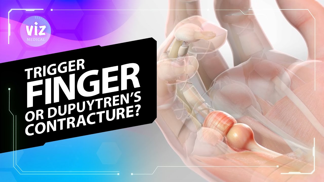 Trigger Finger vs. Dupuytren’s Contracture: What’s the Difference? (3D Animation)