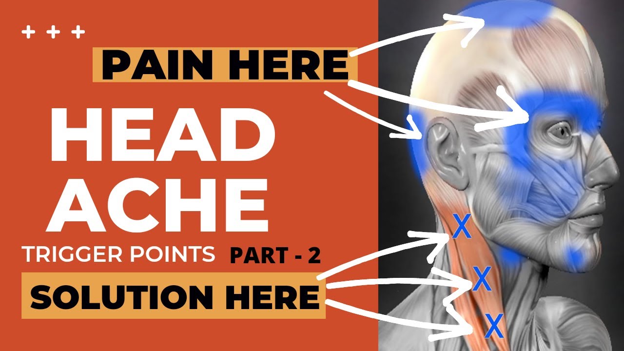 TRIGGER POINT SERIES - PART 2 | TRIGGER POINT EXPLAINED |  TENSION HEADACHE | STRESS HEADACHE
