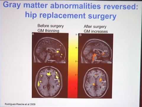 Central Mechanisms of Pain with Karen Davis, Ph.D - RSDSA