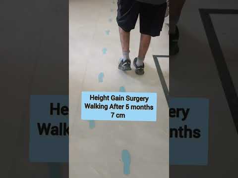 Limb Lengthening Surgery Walking After 5 months | #limblengtheningsurgery #Shorts
