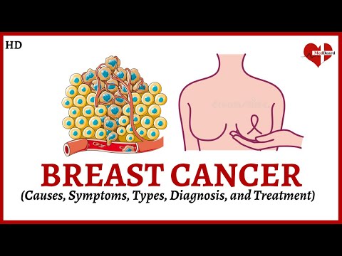 Overview of Breast Cancer: Causes, Symptoms, Types, and Treatment Explained