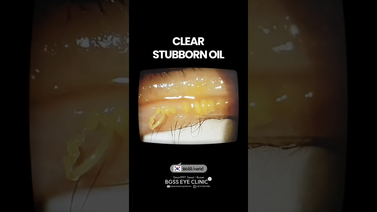 ✈️💡One Flight. Two Eye Problems Solved.