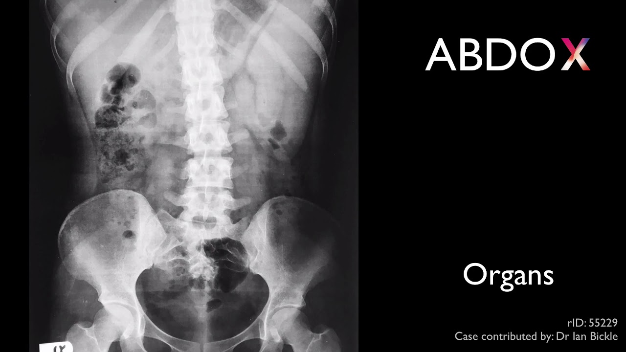 ABDO X - approach to abdominal x-ray interpretation