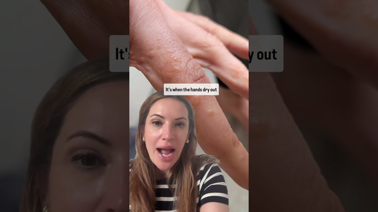Itchy bumps on your hands? It may be this type of eczema