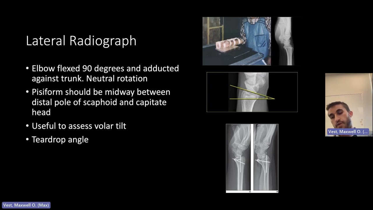 Distal Radius Fractures - Dr. Max Vest - 05/08/23