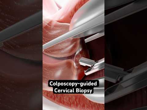 Taking a sample from the cervix (3D Animation)