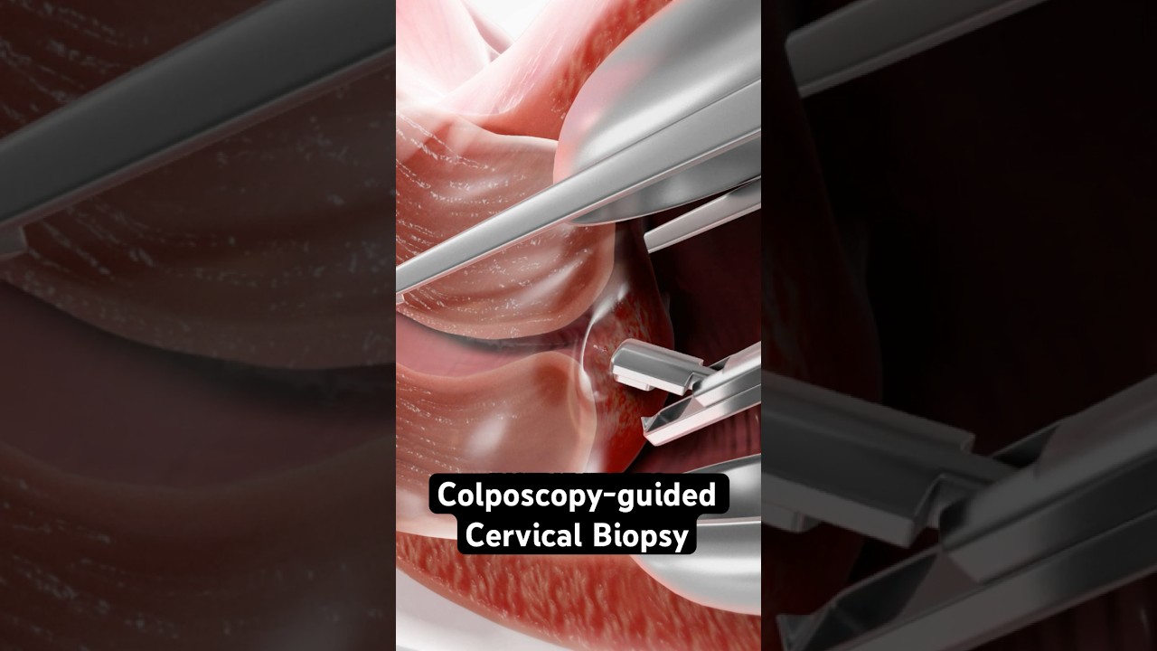 Taking a sample from the cervix (3D Animation)