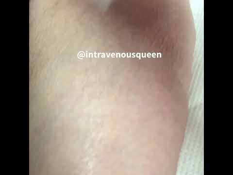 Elderly and Obese Patients - Using “C” Maneuver For IV Insertion by Intravenousqueen