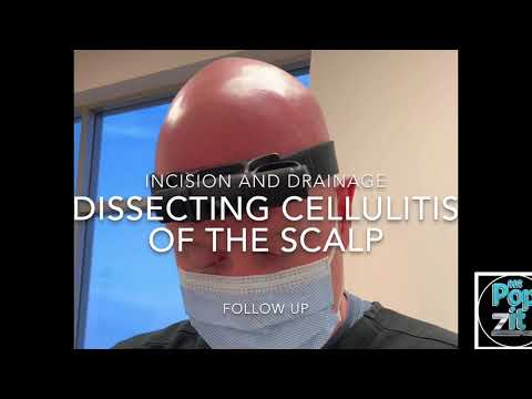 Dissecting cellulitis of the scalp. I+D of pus pockets. Drainage of purulent discharge. MrPopZit