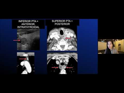 Basics of Parathyroid - MRI Online