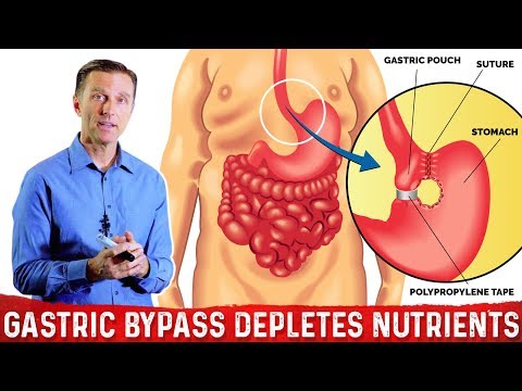 Key Vitamin Deficiencies After Bariatric Surgery – Dr.Berg