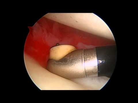 Shoulder arthroscopic capsular release for frozen should (adhesive capsulitis)