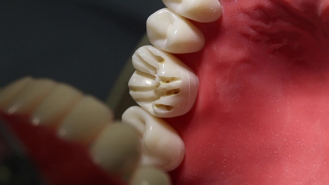 Full Zirconia Crown Prep #3 (rounded shoulder) - Dr. Mark R. Taylor