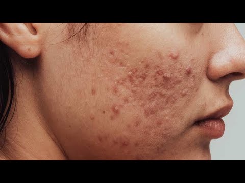 Acne | treatments