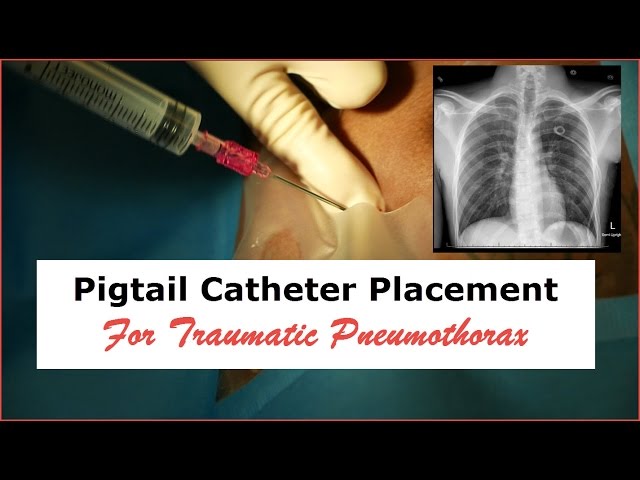 COOK - Evolution Esophageal Stent System Manufacturer from New Delhi