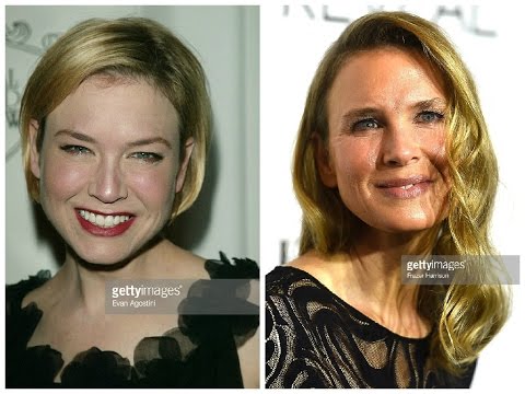 Renée Zellweger Plastic Surgery Before and After Photos