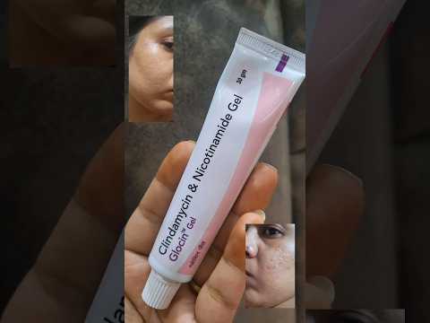 glocin gel review |If you have any doubts of glocin gel check this| clindamycin & nicotinamide gel