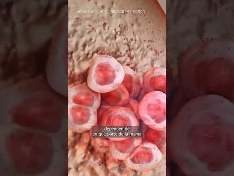 El CÁNCER de MAMA en 1 minuto