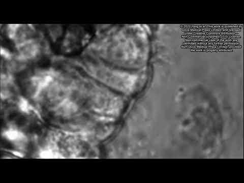 Novel OFD1 Variant in Ciliary Dyskinesia - Supplementary video 1 [ID 365740]