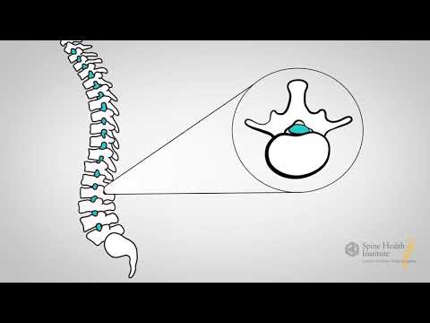 What Is Lumbar Stenosis?