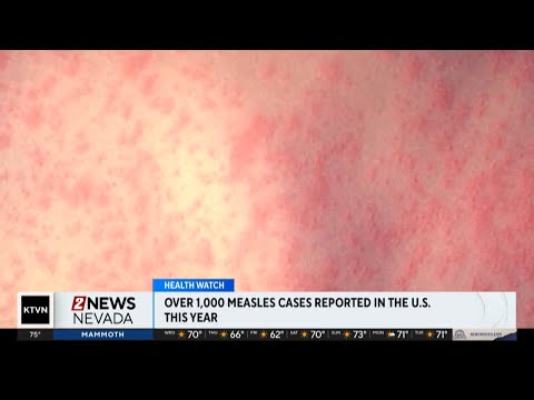 More than 1,000 measles cases in the U.S.