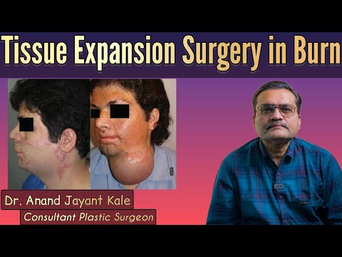 Tissue Expansion Surgery in Burn | Dr Anand Jayant Kale