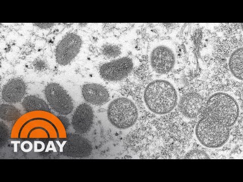 Monkeypox Concerns Grow As US Reports Second Possible Case