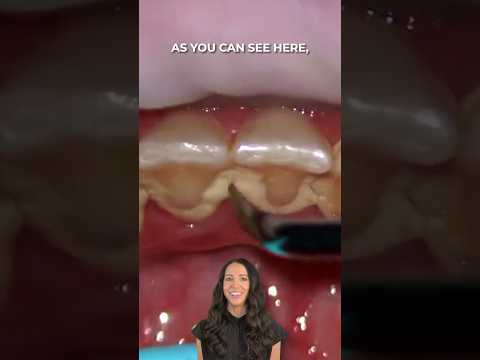 deep teeth cleaning at the dentist #shorts