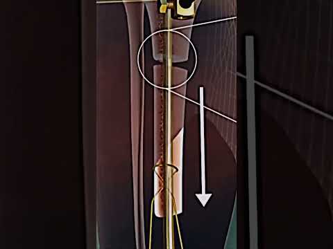 Leg Rod Placement 3D animated #medicoabdullah #shortsyoutube