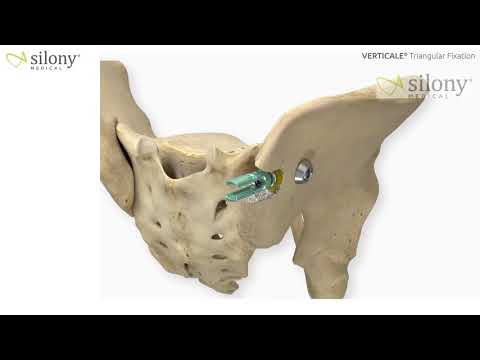 Silony Medical: VERTICALE® Triangular Fixation