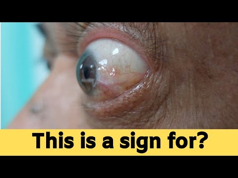 What is the cause of bulging eyeballs?: Symptoms- Treatment-Prevention: Graves disease exophthalmos