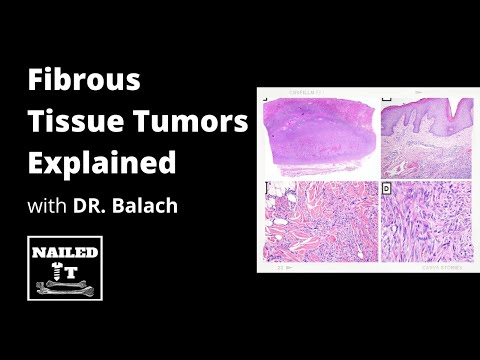Fibrous Tissue Tumors Explained