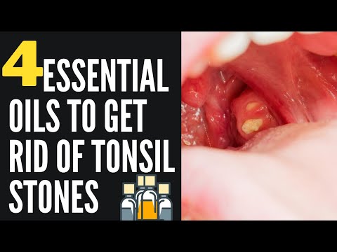 4 Essential Oils For Oral Health To Get Rid Of Tonsil Stones