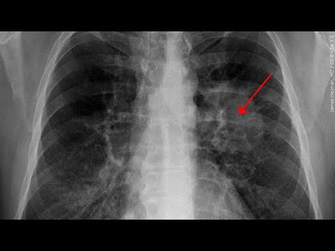 UVM researcher makes strides in treatment for rare form of lung cancer