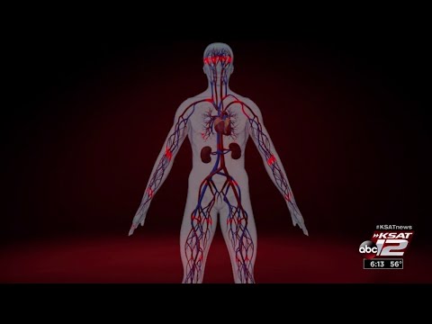 Chronic mesenteric ischemia: Not just a stomach ache