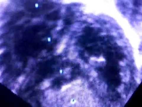 Rhabdomyoma of heart :Prenatal diagnosis