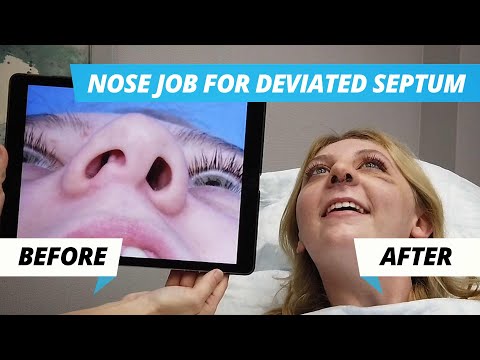Nose Job Surgery for Deviated Septum – Rhinoplasty to Improve Crooked Nose