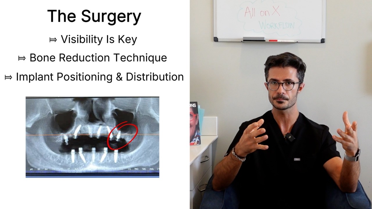 Full-Arch Implants: My All-on-X Protocol (2026)