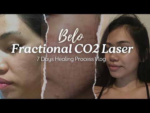 BELO Fractional CO2 Laser Healing Process | DOES IT REALLY WORK? (what you should expect and cost)