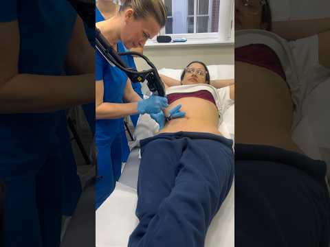 Stomach Stretch Marks Removal With Cool Laser in London’s Clinic