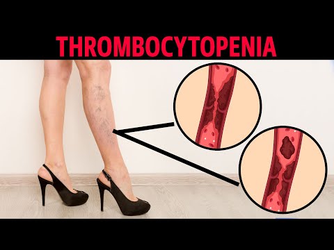 What is Thrombocytopenia