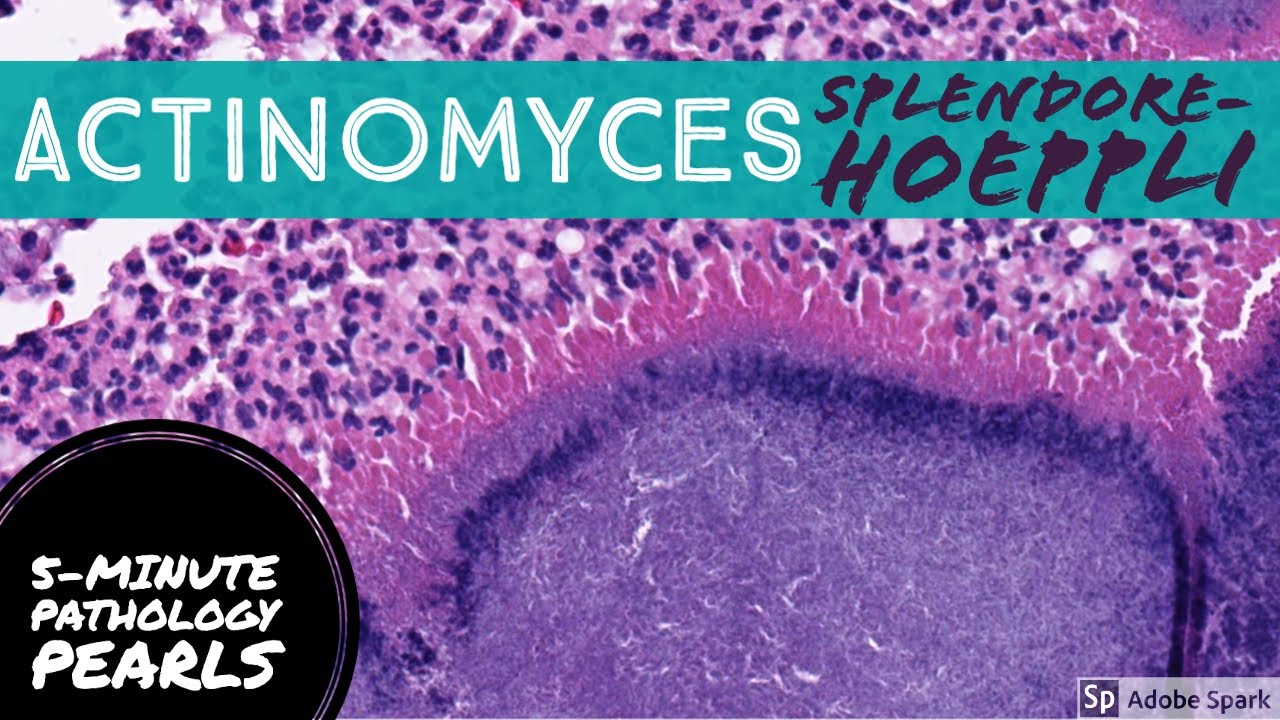 Actinomyces (Actinomycotic Mycetoma) with Splendore-Hoeppli phenomenon: 5-Minute Pathology Pearls