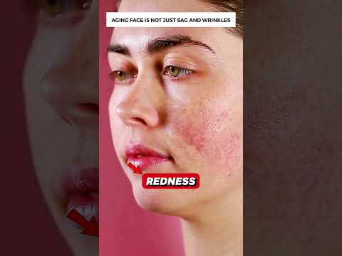 🩸 RED VESSELS ARE AGING YOUR FACE 🩸