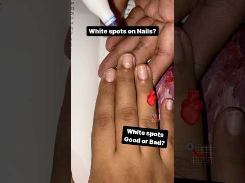 White spots on nails | Palmistry | financial loss sign , bad health sign